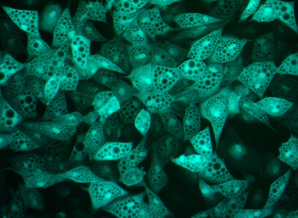 Mikael Rydén's interview - SPHERES Lipid droplet hypertrophy